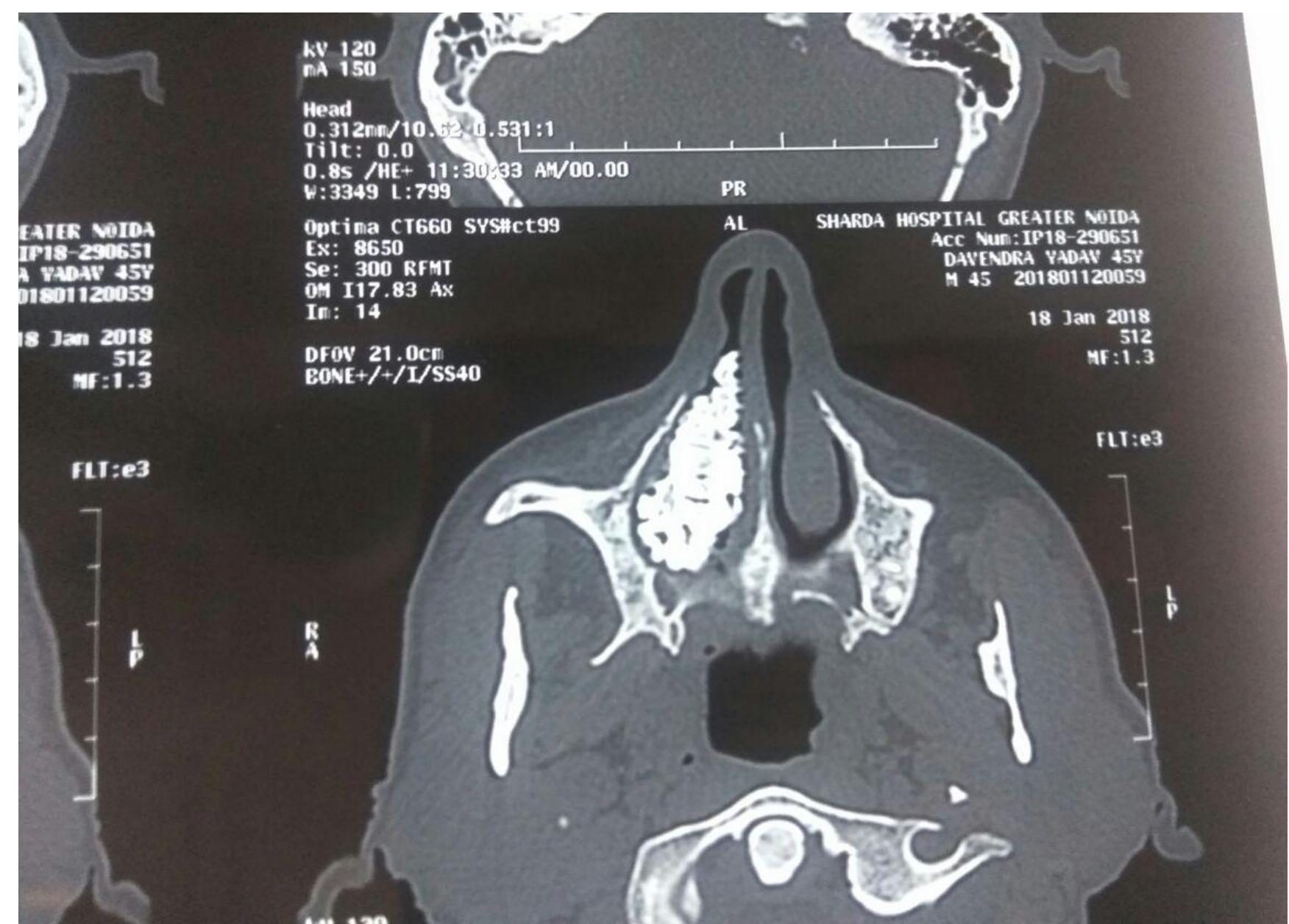 Ncct nose and pns axial view showing hyperdense calcified
