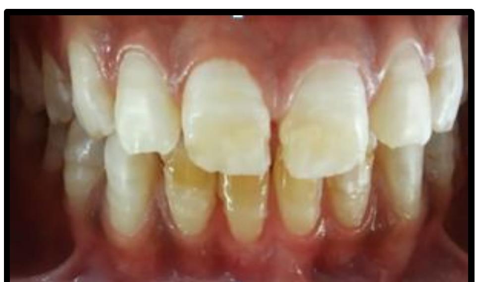 Figure 9 - Aesthetic Management of Discolored Teeth Using