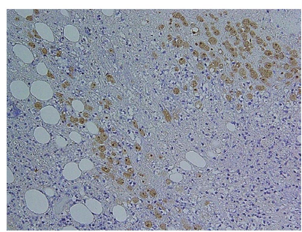 Amebic colitis. immunohistochemical staining of trophozoites