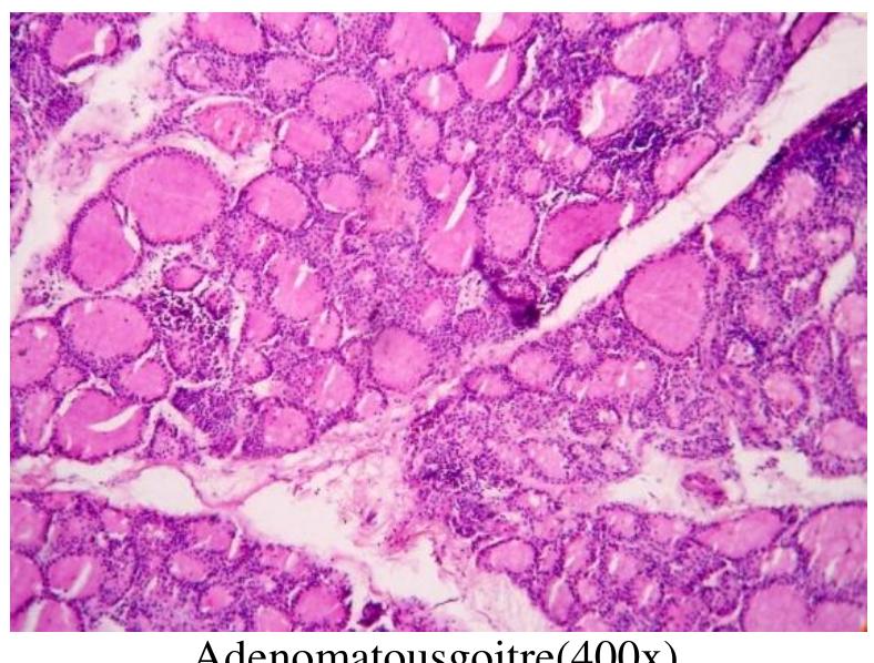 Figure 5 Histopathological Spectrum Of Thyroid Lesions A