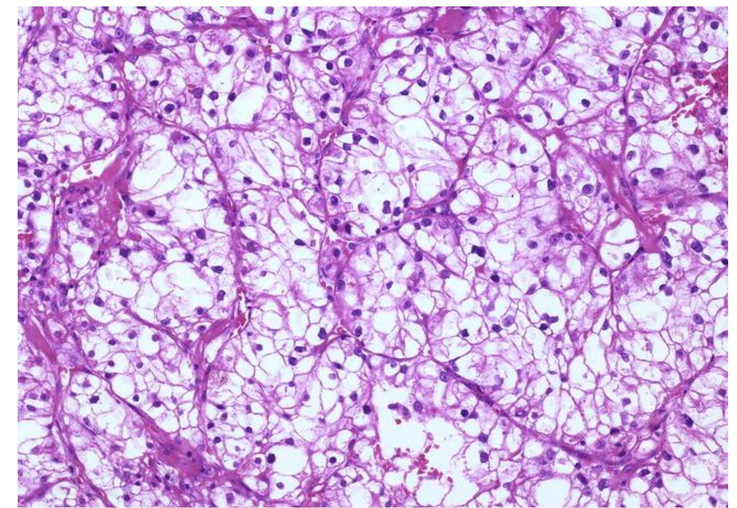 Histopathological spectrum of lesions in nephrectomy