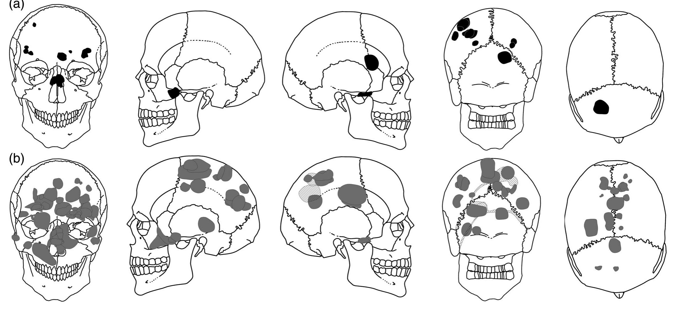 Composite location of antemortem and perimortem wounds. (a)