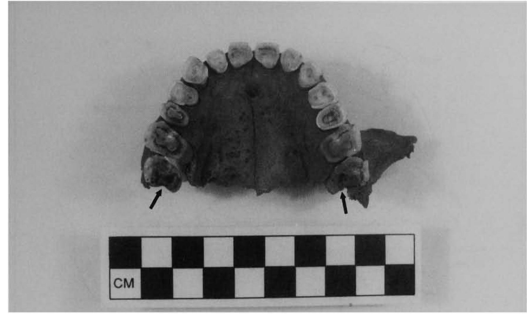 Occlusal view of the maxilla of the royston skeleton. note