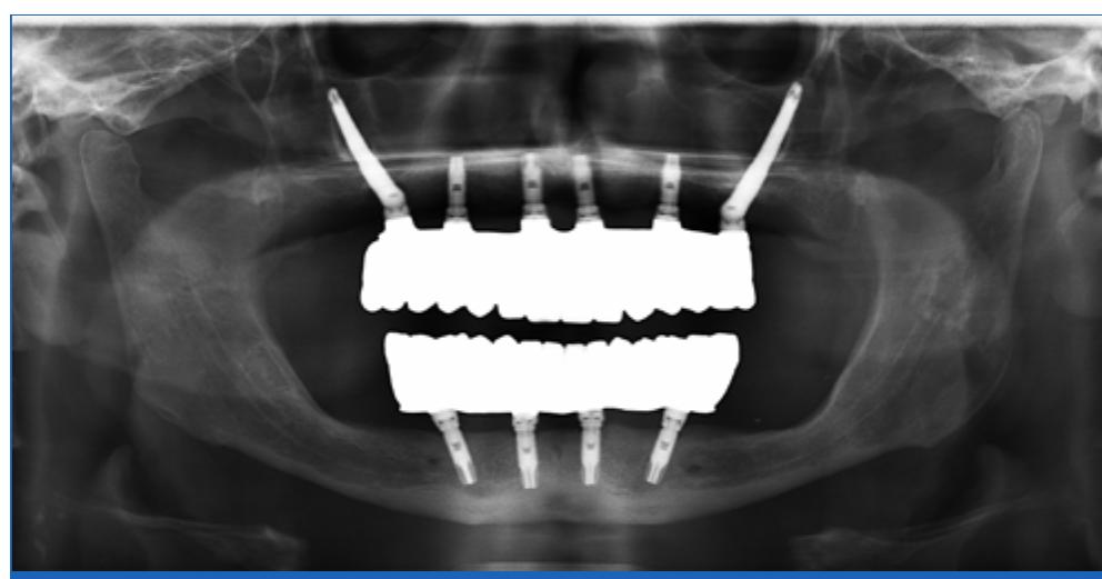 Example of maxilla cc class v, option b and mandible cc