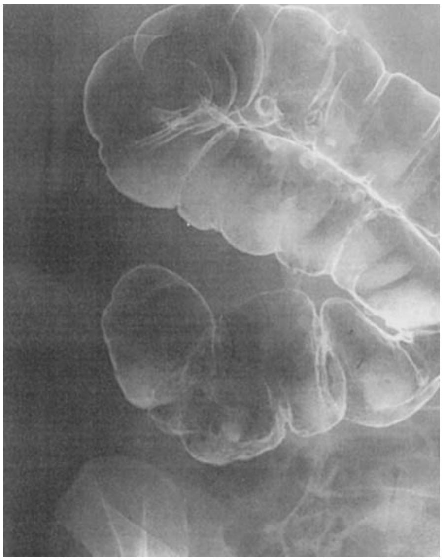 (PDF) APPENDIX AND CECUM Embryology Anatomy and Surgical Applications