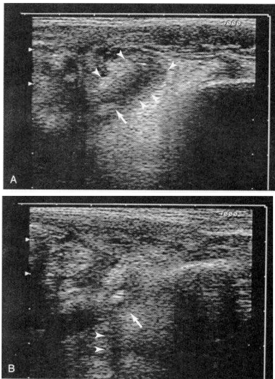 Figure 8 - APPENDIX AND CECUM Embryology Anatomy and
