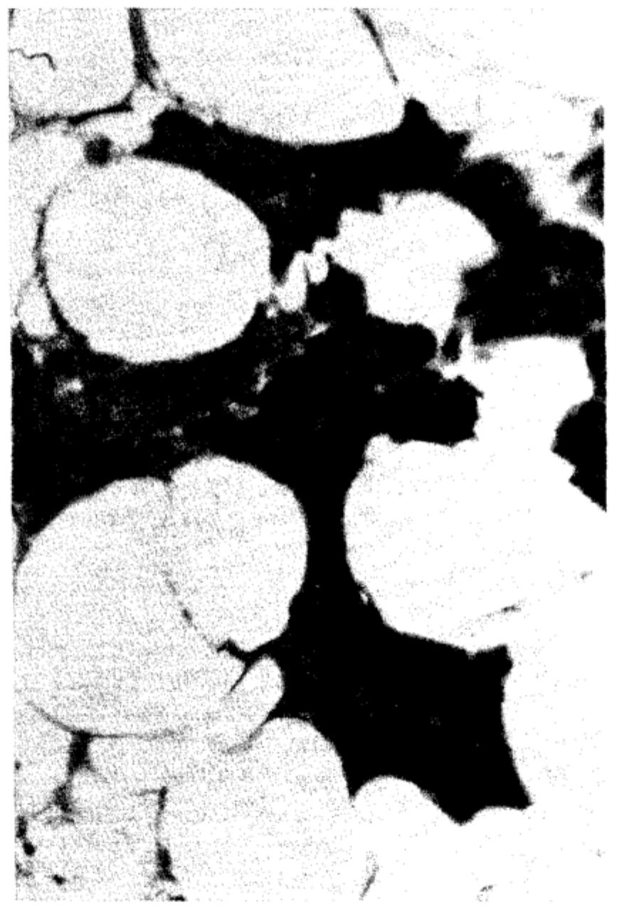 Inflammatory infiltrate with the presence of focal necrosis.