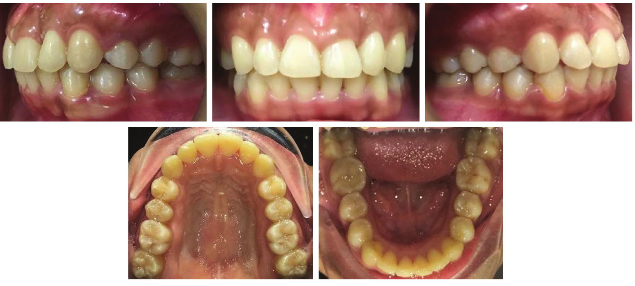 Intraoral post-treatment.