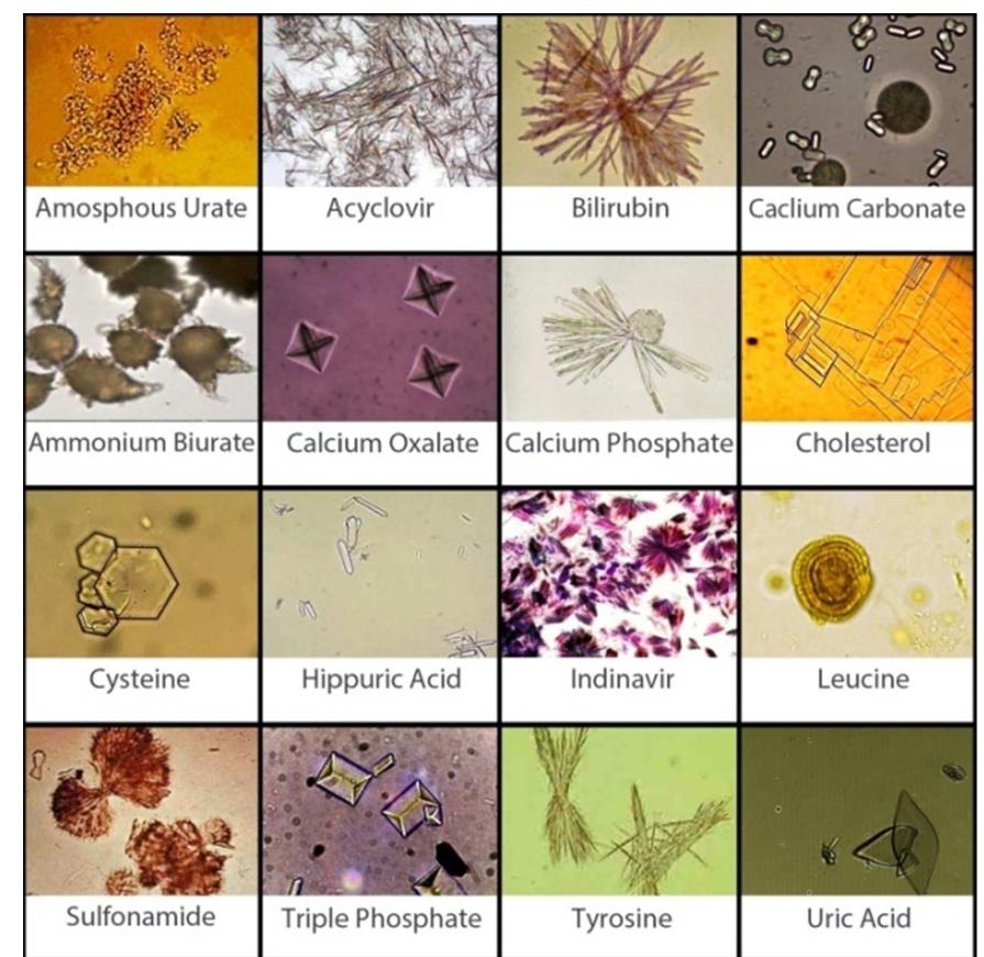 Types of urinary crystals