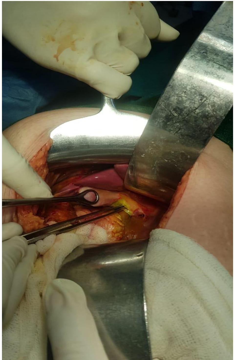 Perforation in distal body of gallblader with impacted large