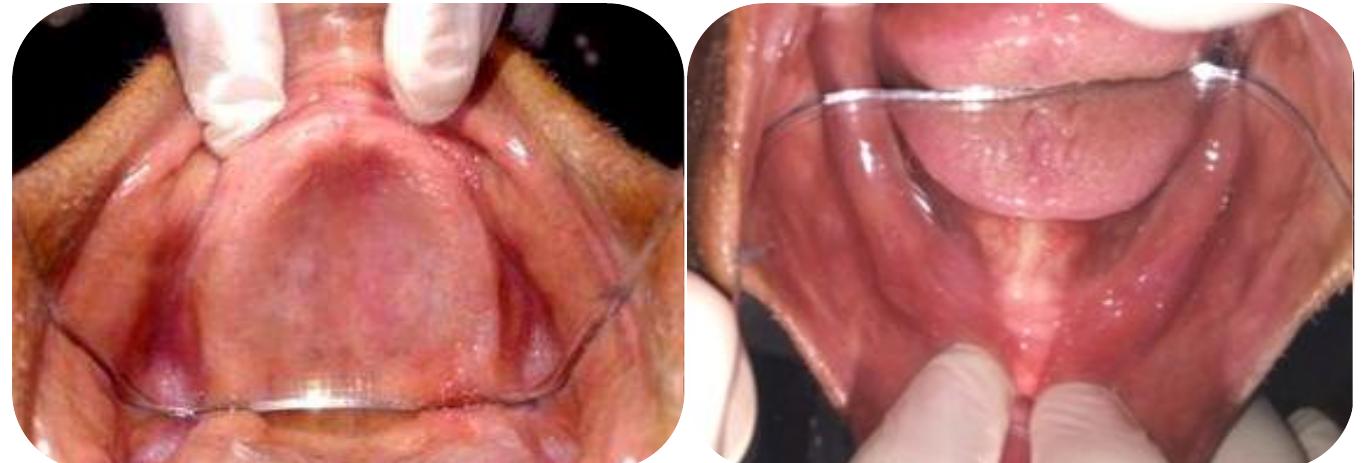 Resorbed edentulous maxillary and mandibular arch’ both