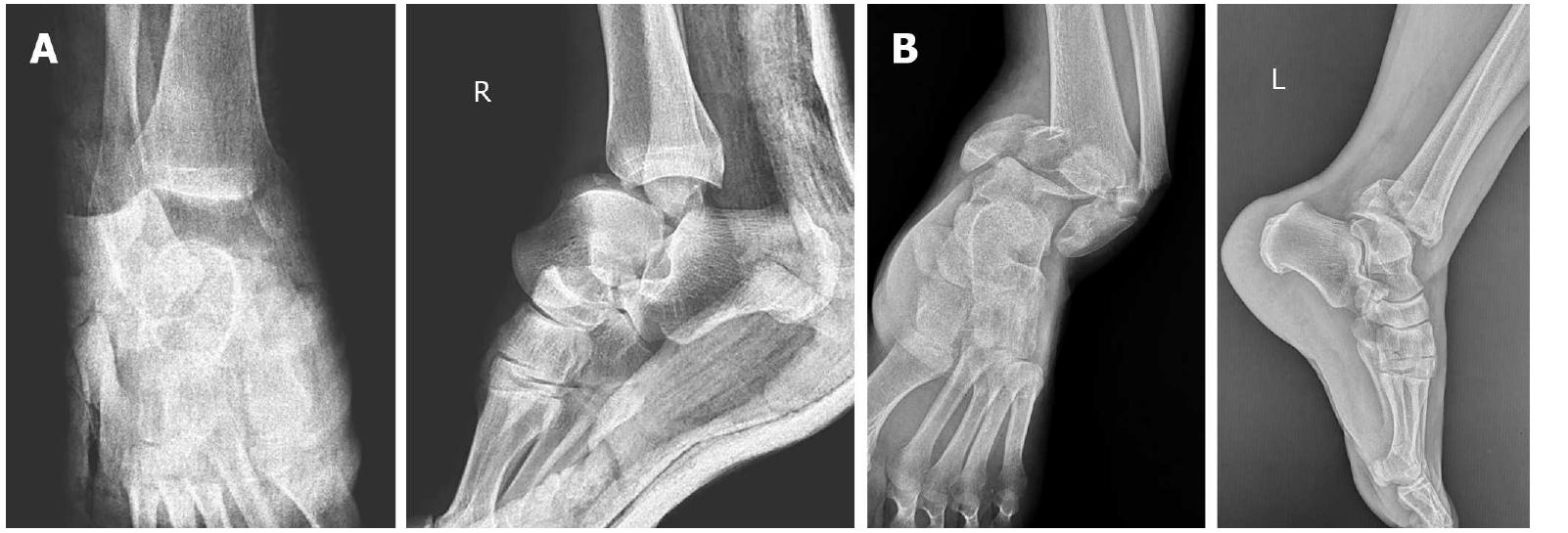 Anteroposterior and lateral ankle radiographs of the right