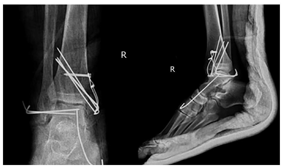 Anteroposterior and lateral ankle radiographs of the right