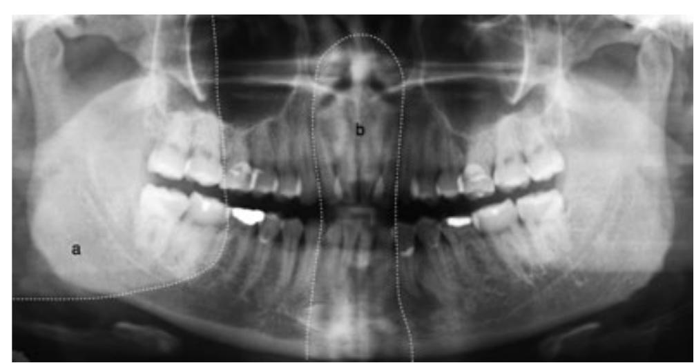 (PDF) Interpretation of panoramic radiographs
