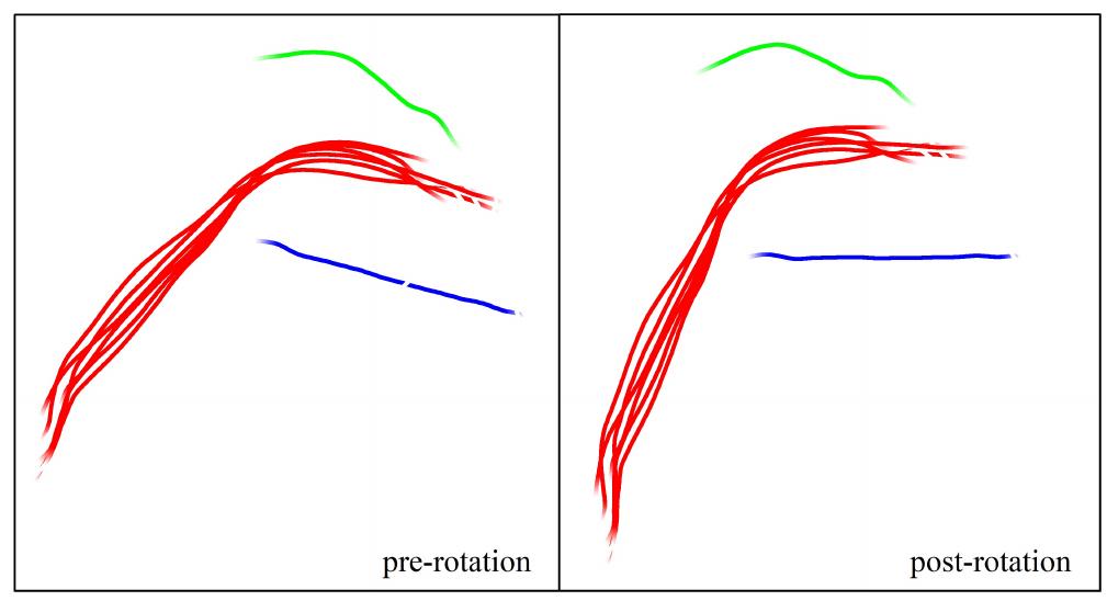 Example of rotation to the occlusal plane. the tongue tip is