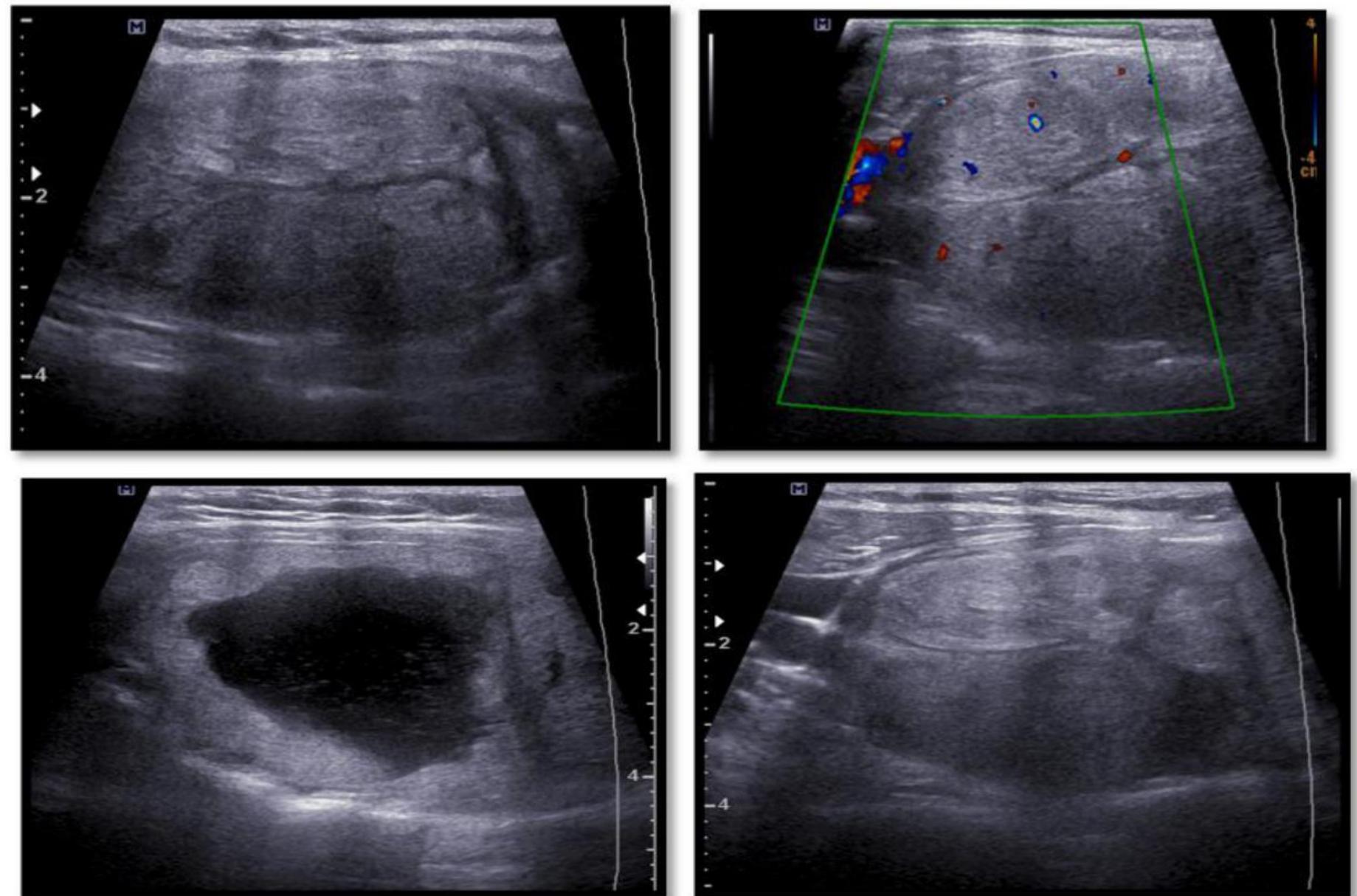 Image no. 7-10 : hrs usg a patient with multinodular goiter