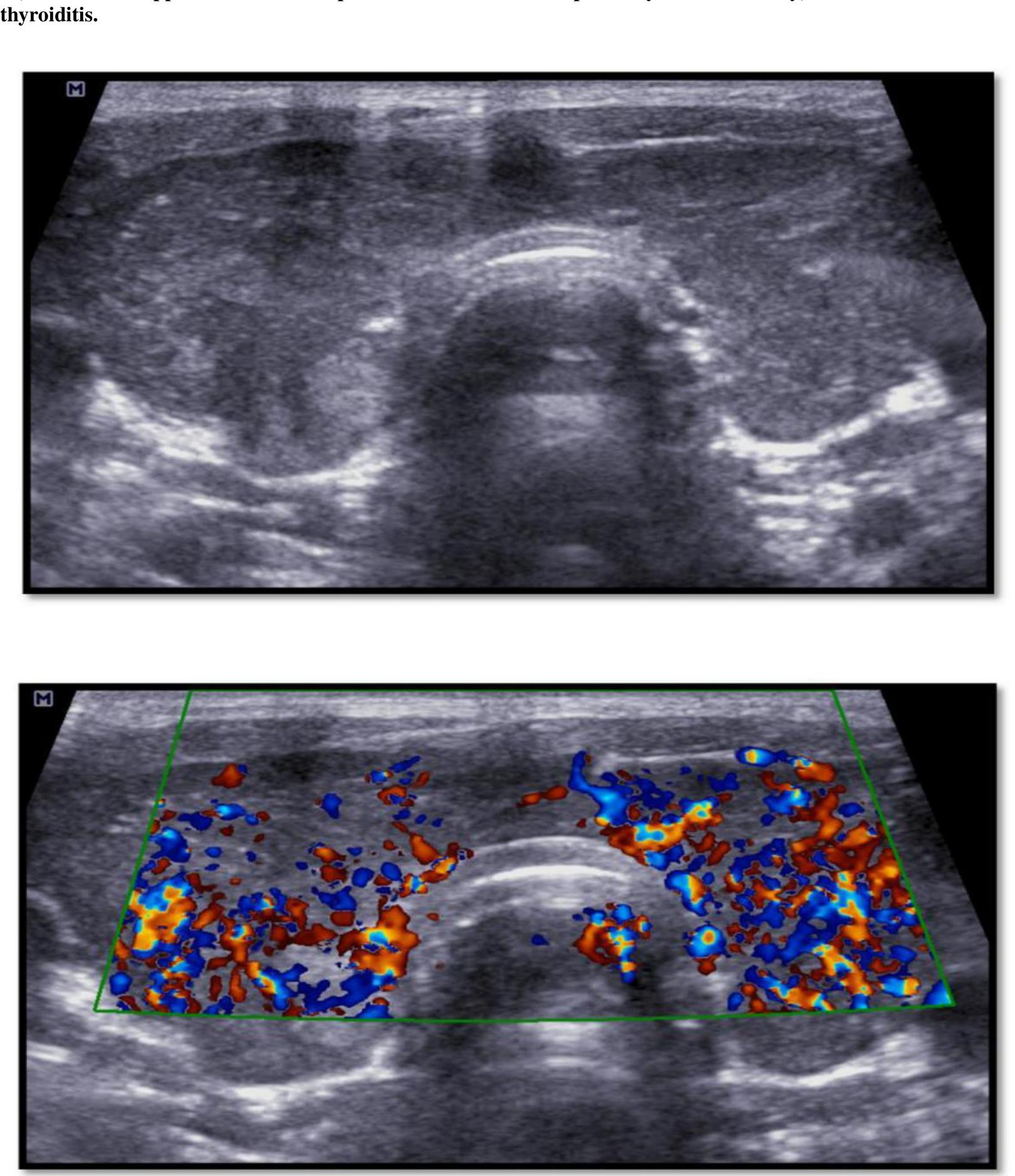Image no. 17,18 : hrs usg showing in a patient of grave’s
