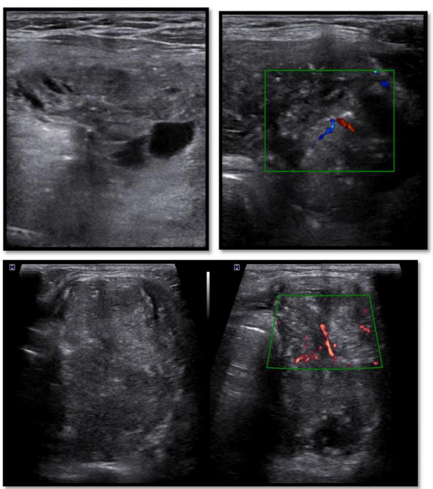 Figure 10 - Ultrasonography of Thyroid Lesions with