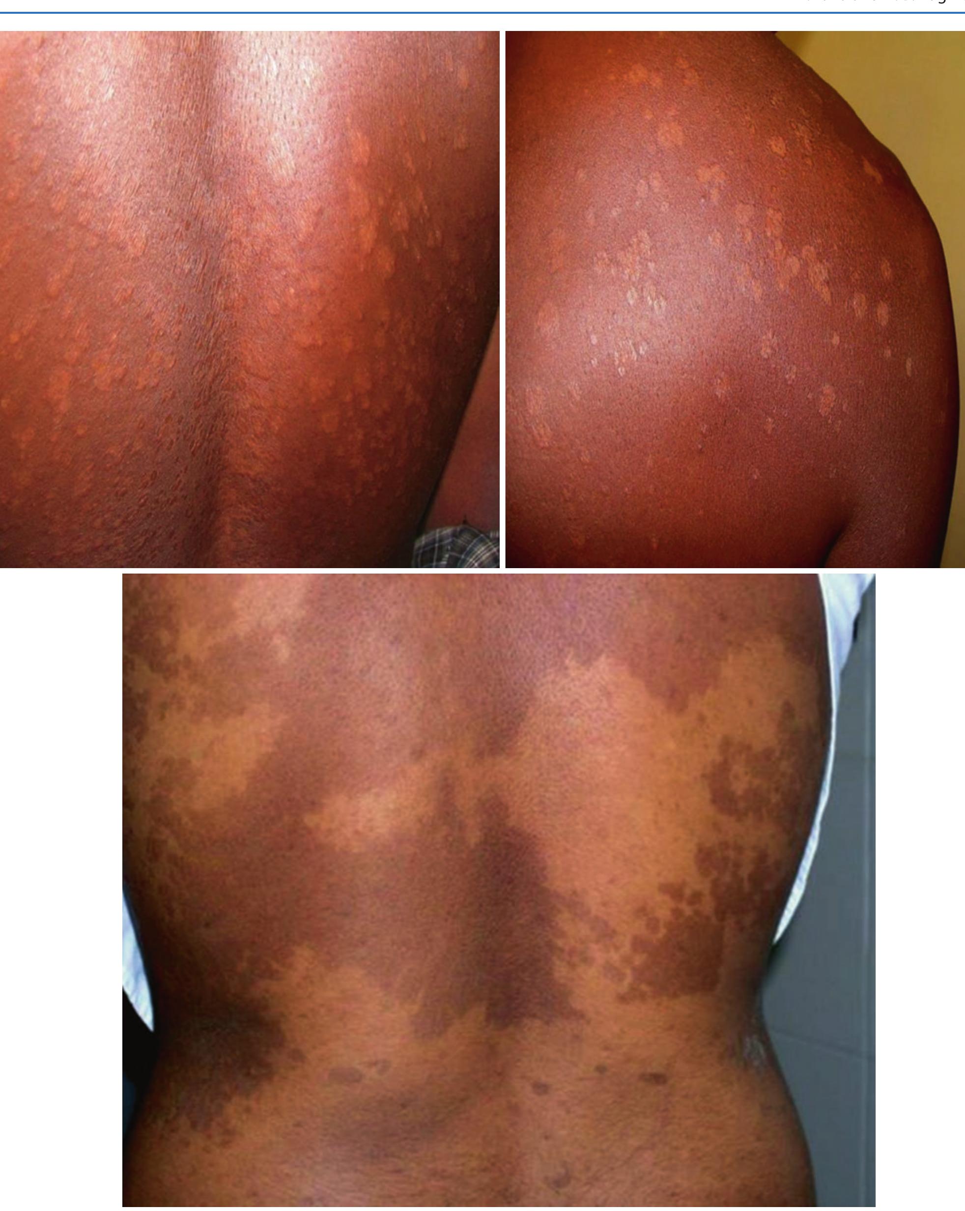 1 clinical types of pityriasis versicolor: small hypochromic