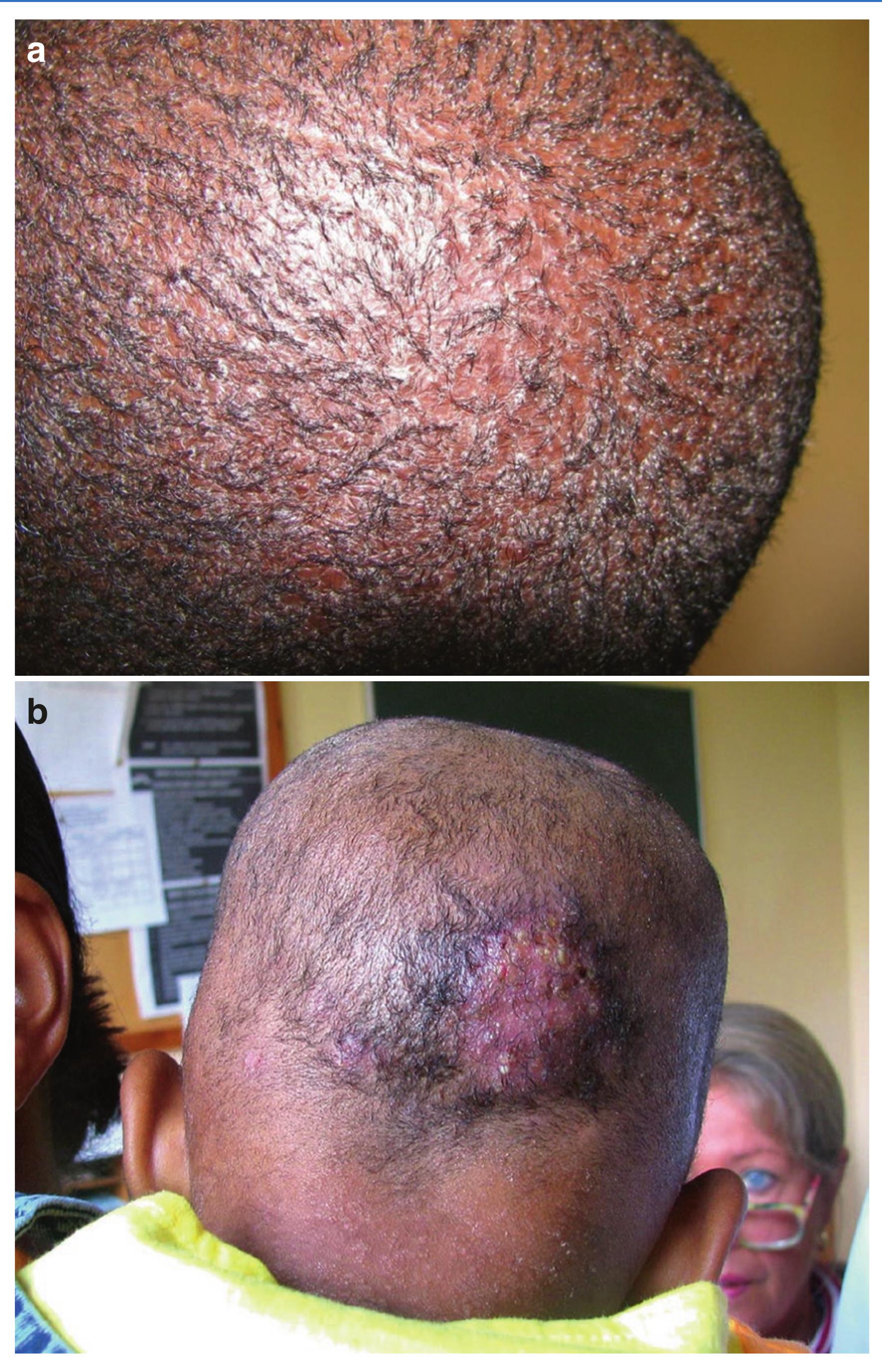 4 tinea capitis. (a). diffuse fine scaling of the scalp with
