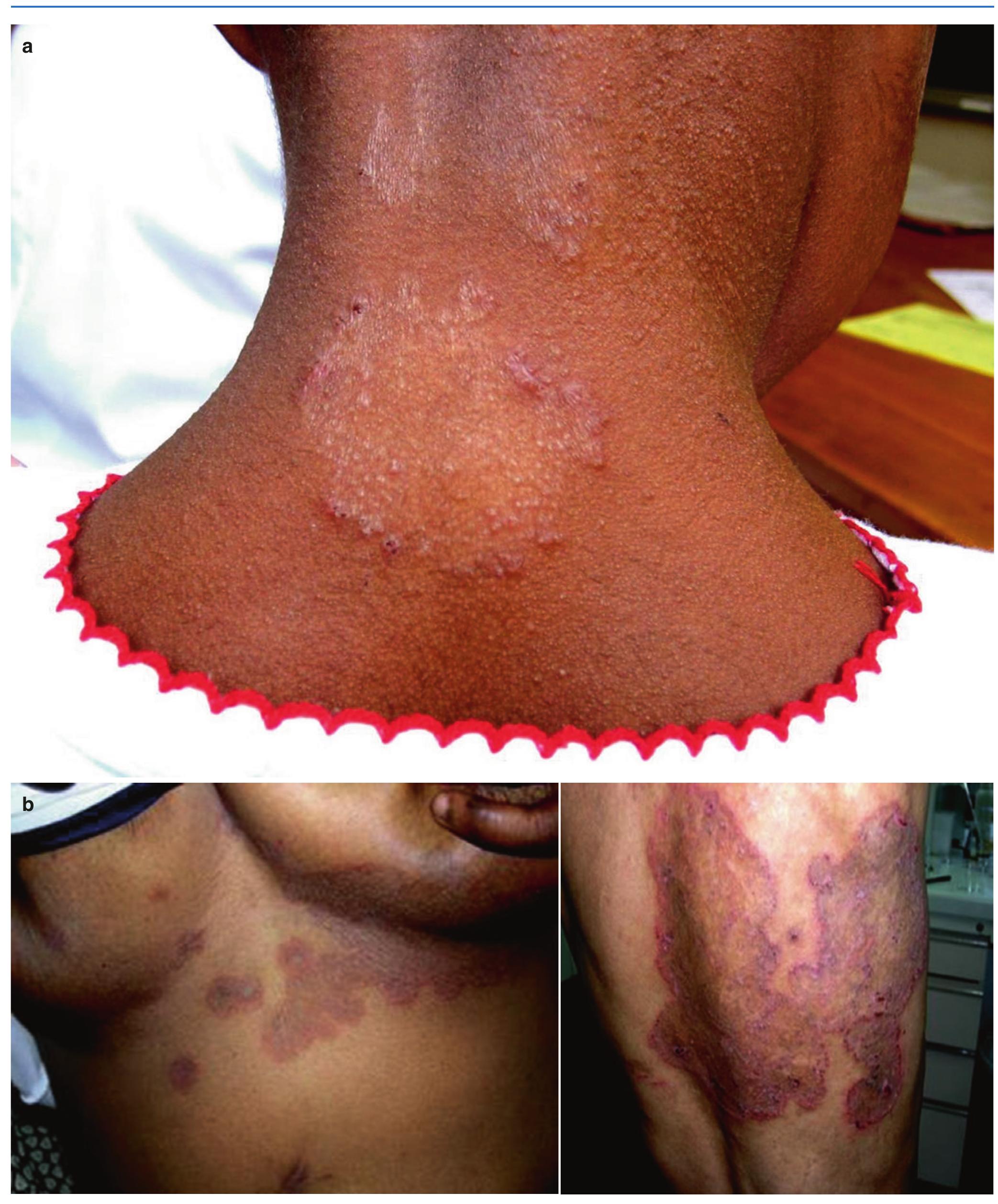 5 tinea corporis: (a). lesion on the neck in a young school