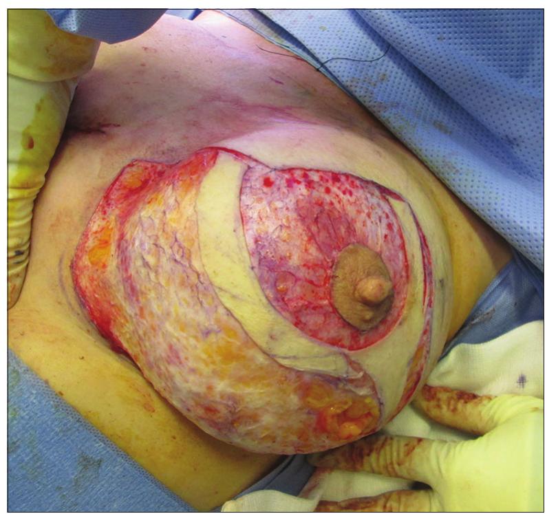 Left breast showing inferior dermoglandular flap and