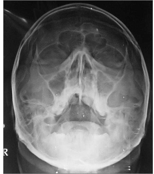 Intraorally, swelling of 3 cm x 3 cm in size in the left