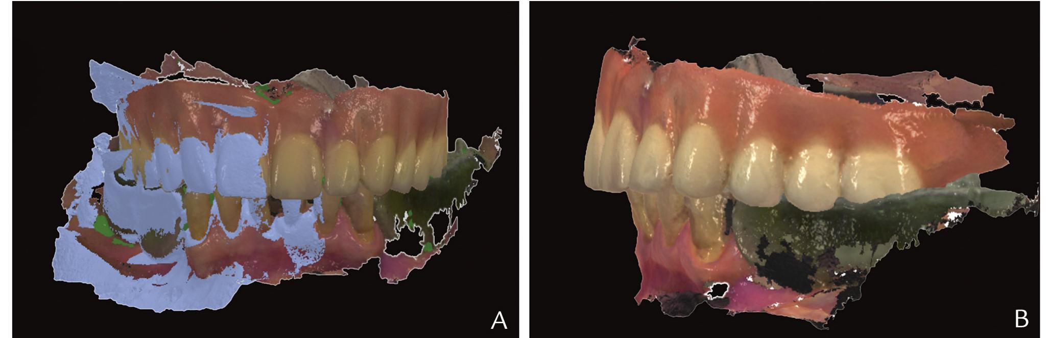 A, frontal. b, lateral view of digital interocclusal