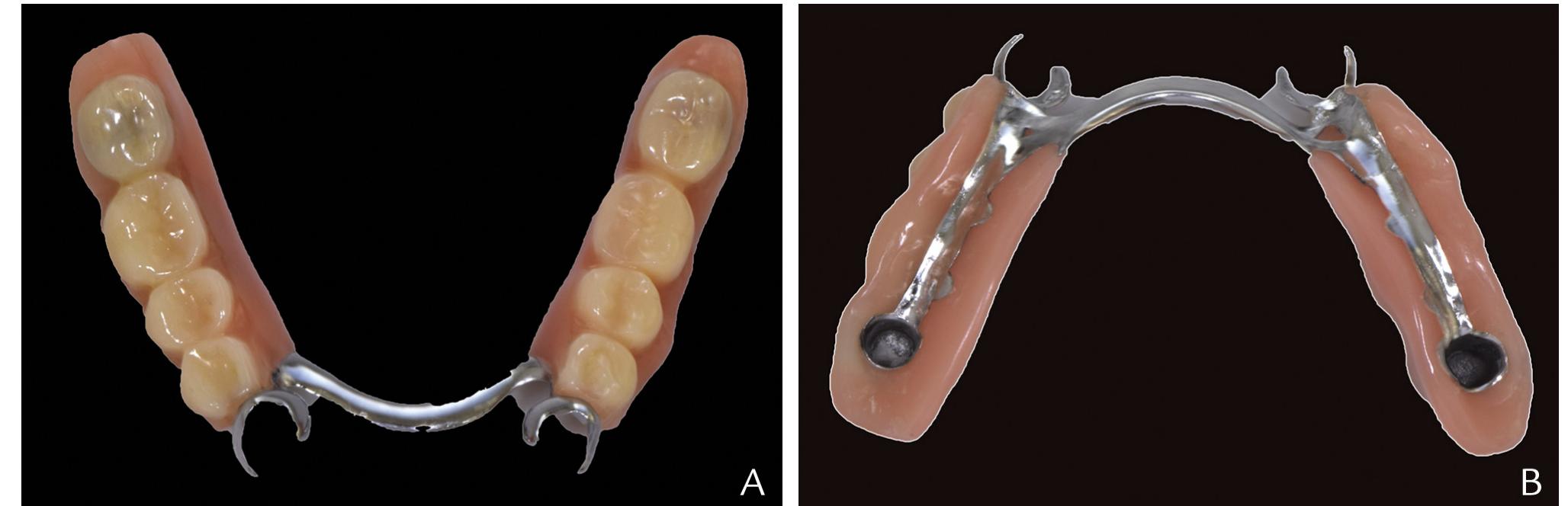 Definitive removable partial denture. a, occlusal view. b,