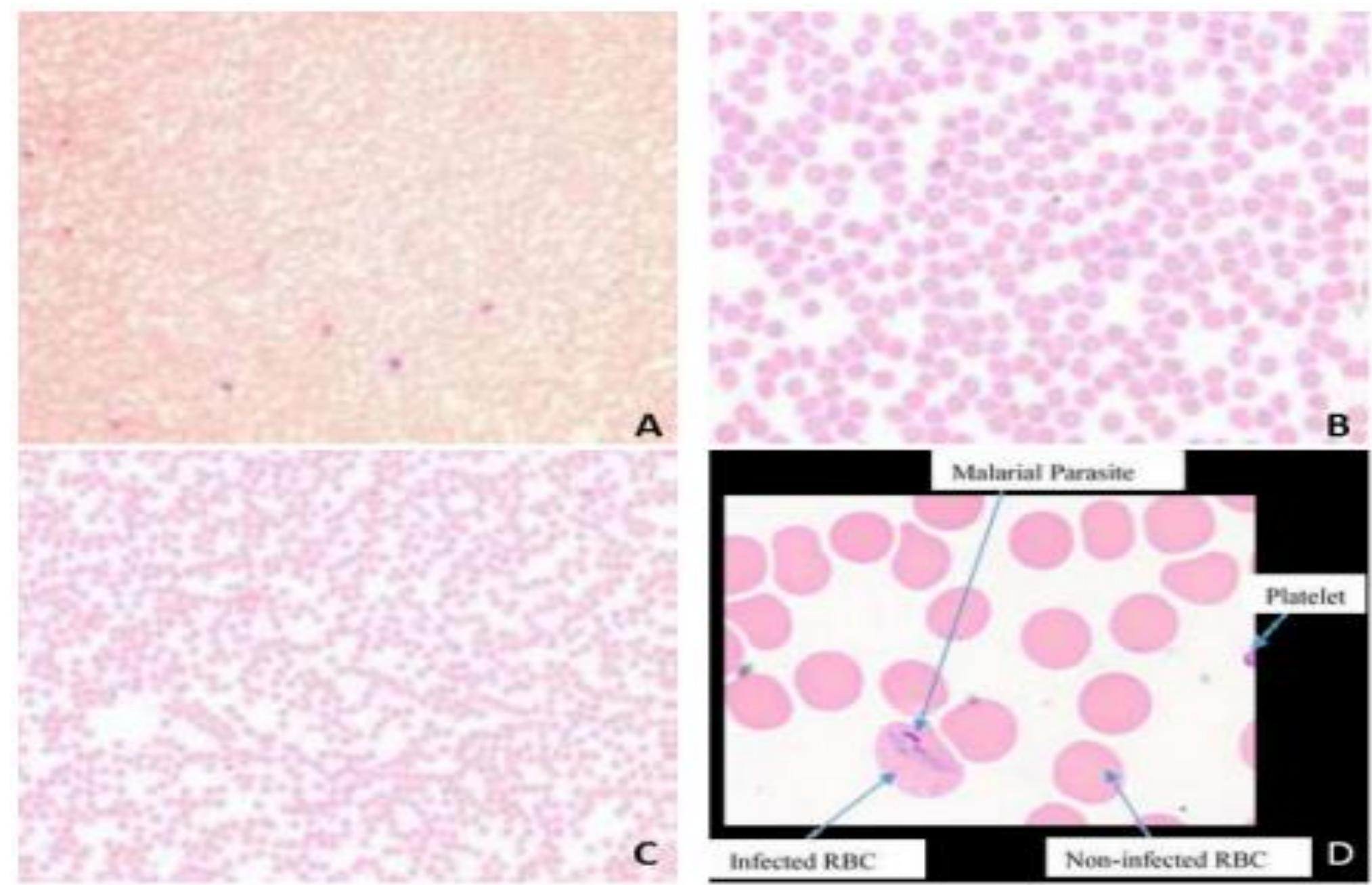 12 the magnified microscopic blood images of the blood