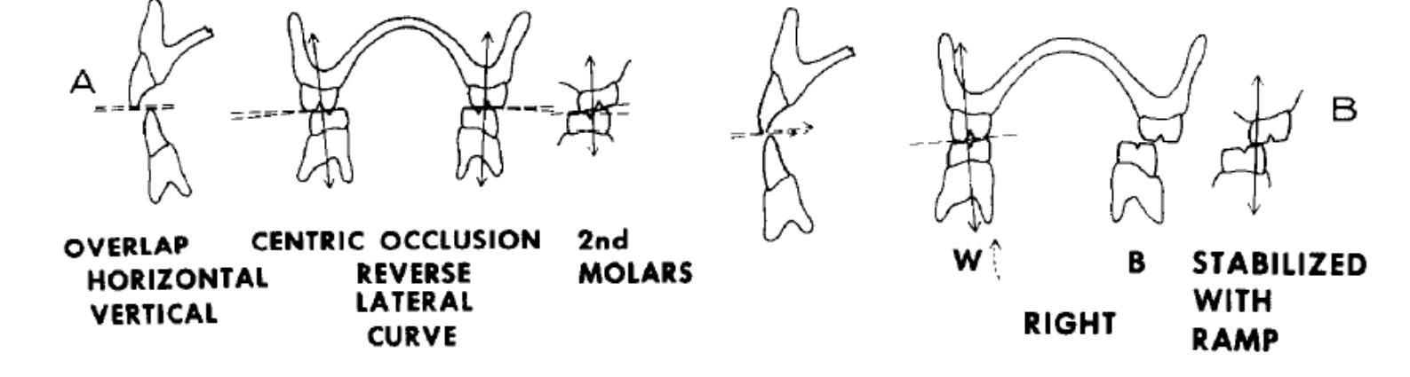 (a)an arrangement of teeth with a reverse lateral curve