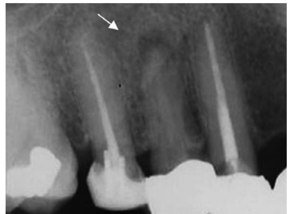 A periapical radiographic image depicting a periapical