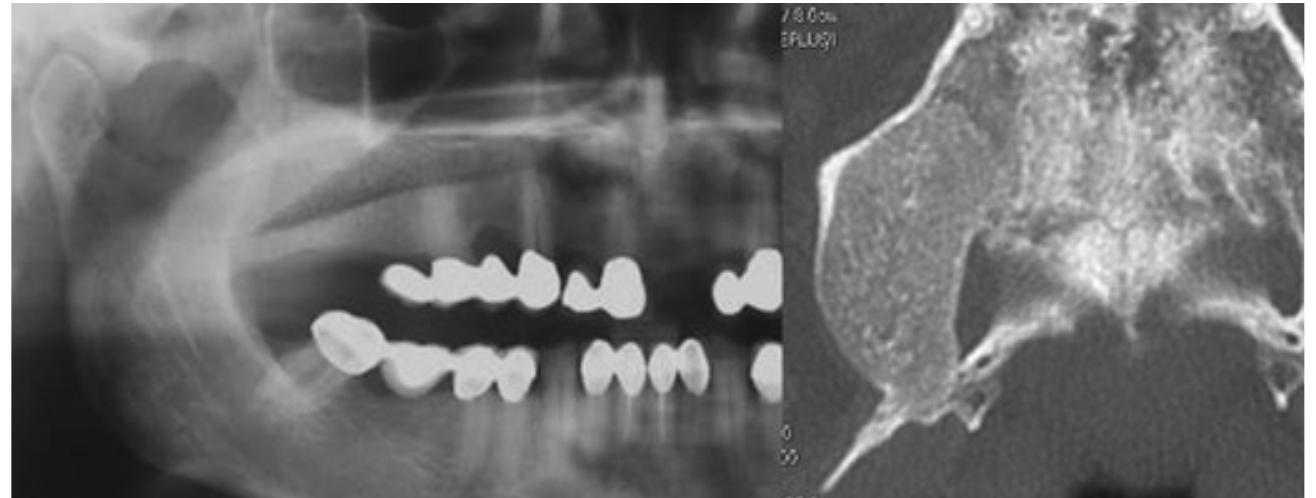Fibrous dysplasia of the right posterior maxillary alveolar