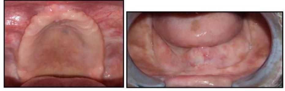 Intra-oral view inter-ridge distance and the ridges were in