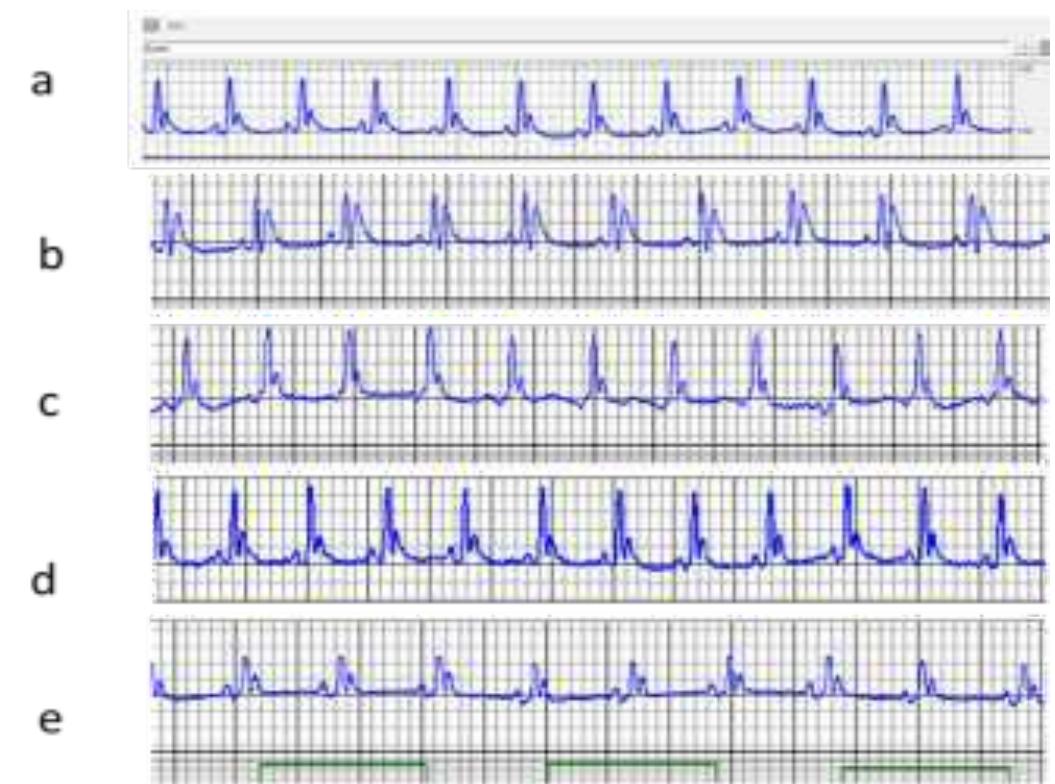 Normal ecg of control negative a , abnormal ecg control