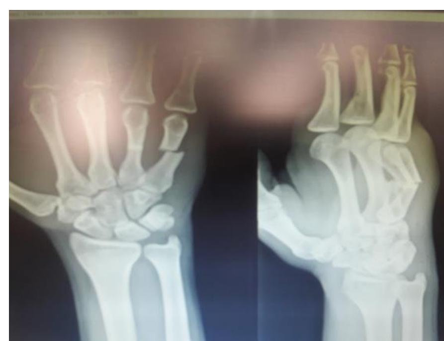 4 and 5‘ mc shaft fracture