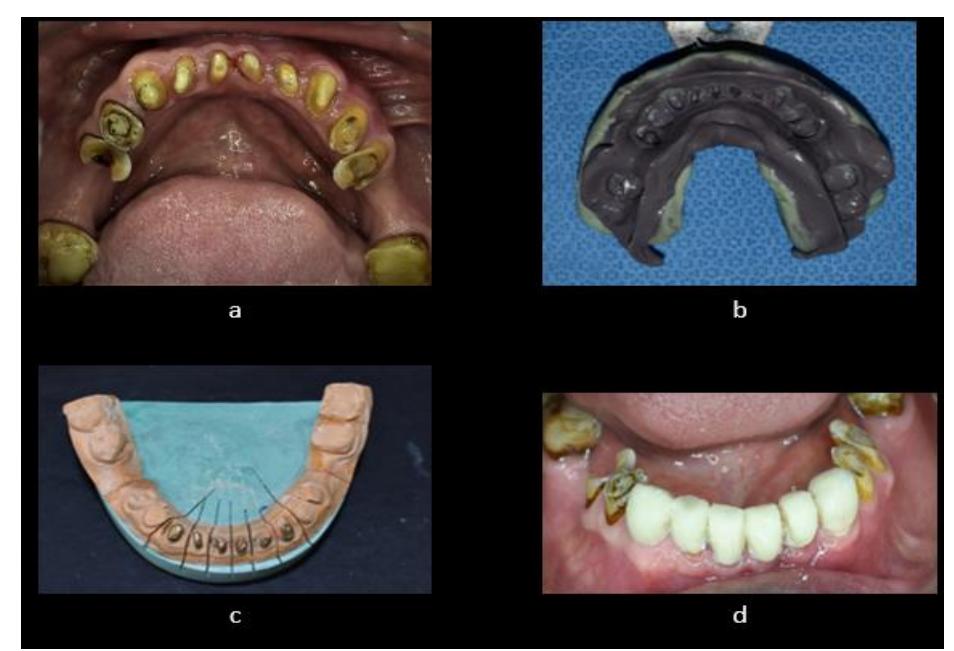 Pre-treatment. a): maxillary arch, b): mandibular arch, c):