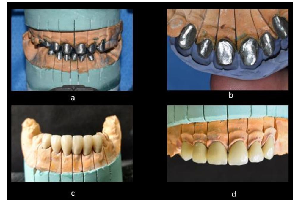 A): maxillary and mandibular anterior metal copings, b):