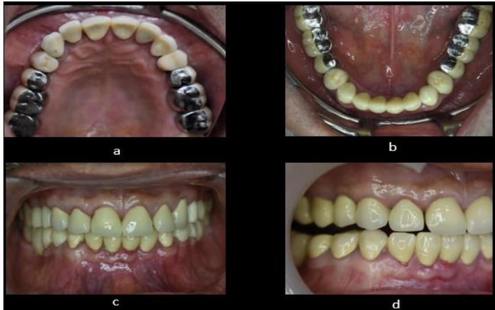 Post-treatment. a): maxillary arch, b): mandibular arch, c):
