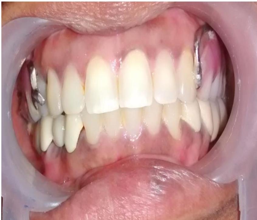 Post insertion occlusion of fpd with non rigid connector