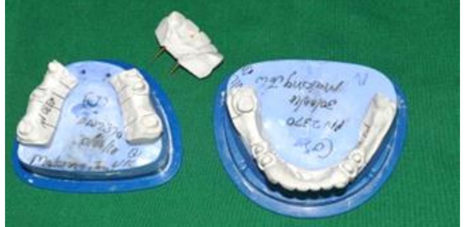 Maxillary and mandibular final models with maxillary