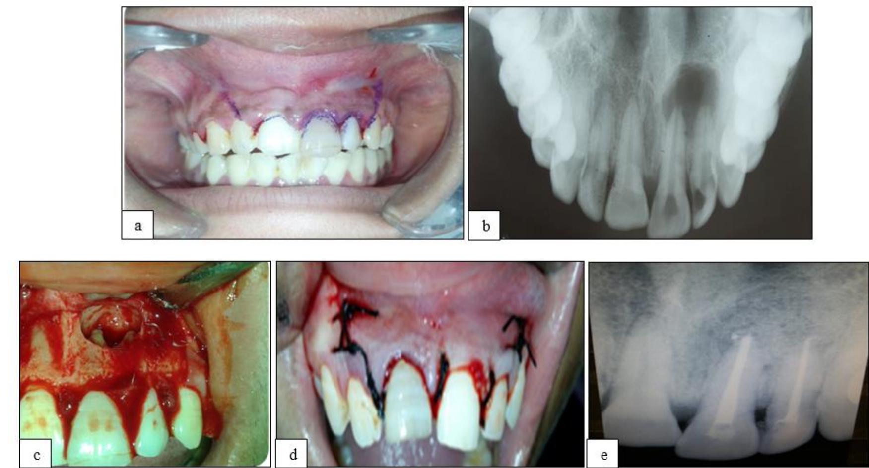 La: preoperative #21; b: preoperative radiograph; ce: flap