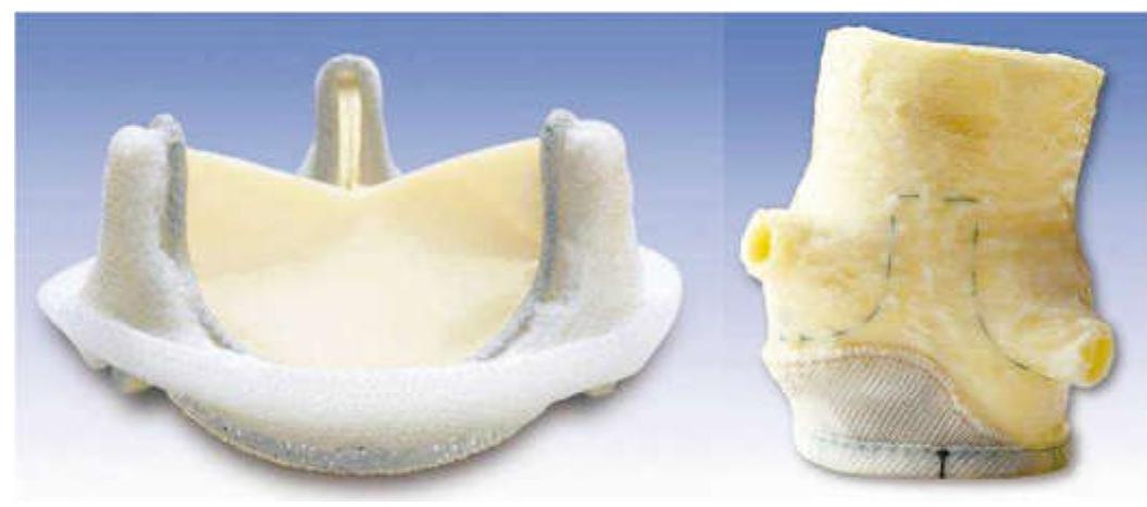 -11. carpentier-edwards perimount™ pericardial valve and