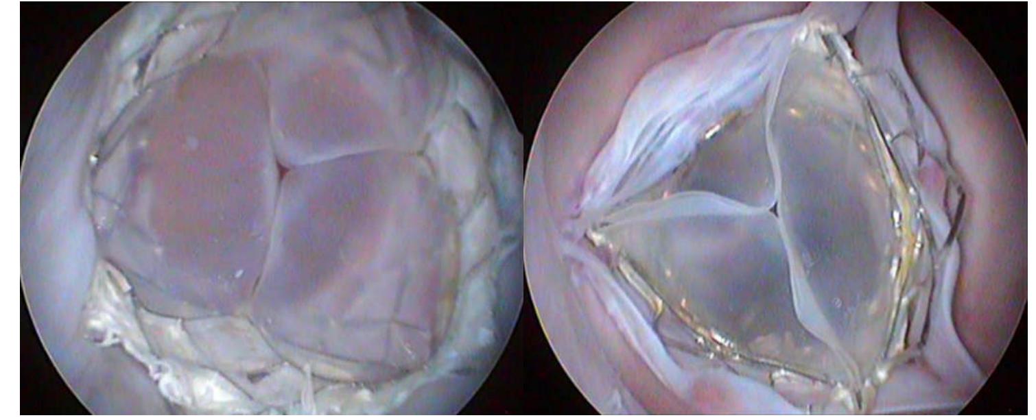 -33. endoscopic images of deployed design 2 valves, from the