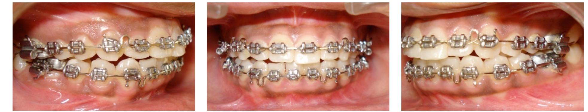 Figure 2 - Mandibular Incisor Extraction -Case Report