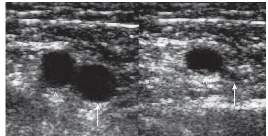 Normal femoral vein (left) and femoral venous thrombosis