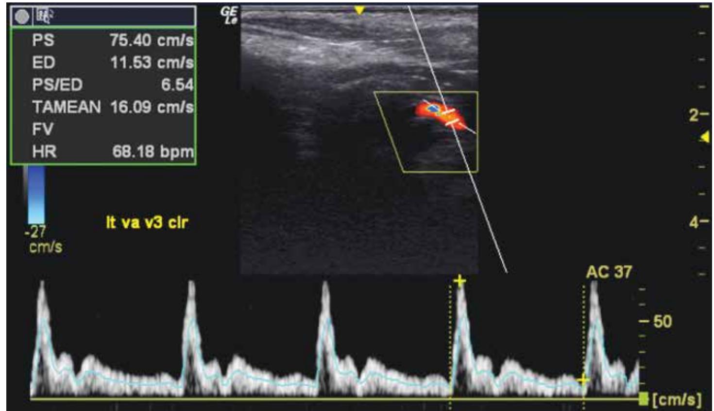 Duplex examination of the distal v3 segment of the vertebral