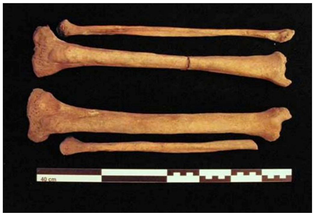 Example of remodeled tibial periosteal reactions from cen-