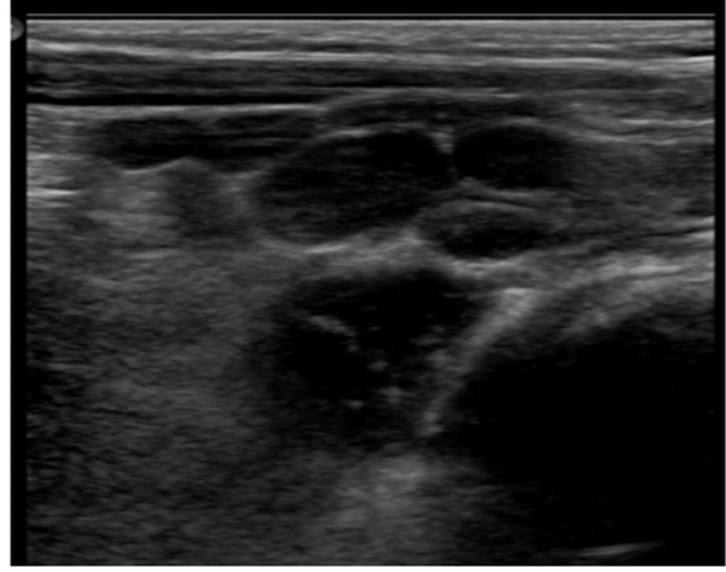 Ultrasound image, shows enlarged lymph nodes in the right