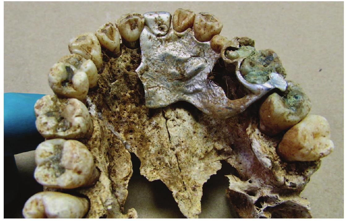 5 inferior view of the removable partial denture in the left